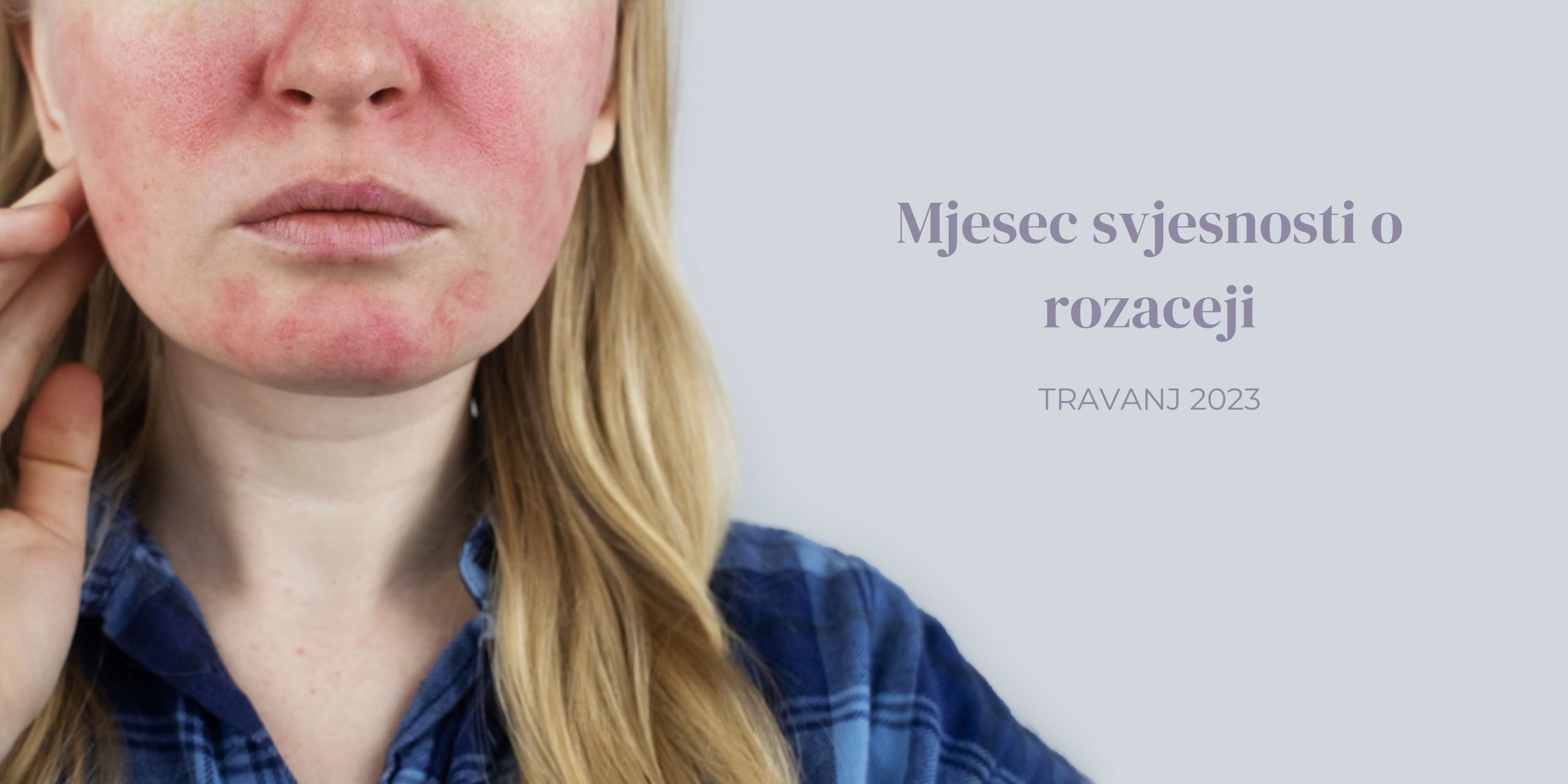 Rozaceja - sve što trebate znati - Rosalique